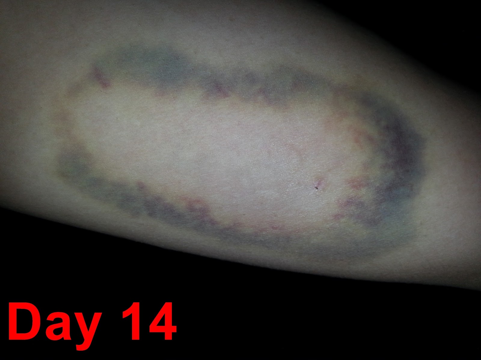 My experience with the birth control Implanon