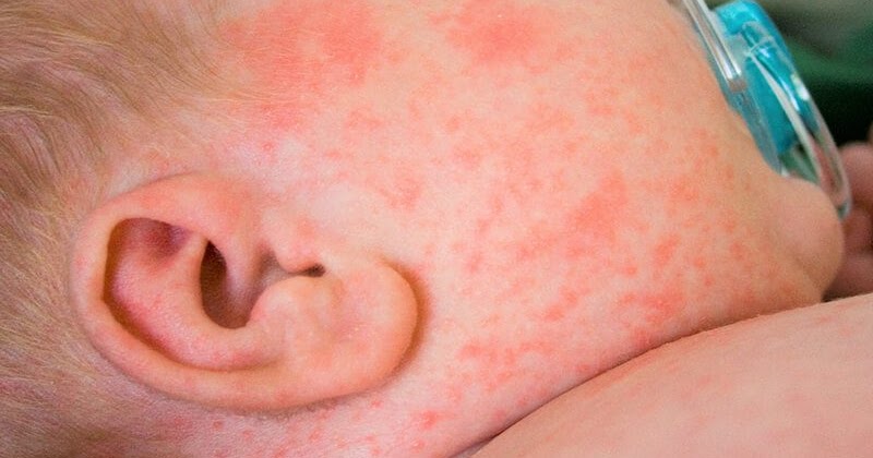 BAGAIMANA SAYA DAPAT MENGELAKKAN RUAM PANAS BERLAKU PADA BAYI SAYA