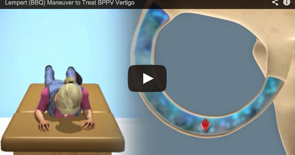Video of Lempert (BBQ Roll) to Treat BPPV (Horizontal Canal) | Fauquier ...