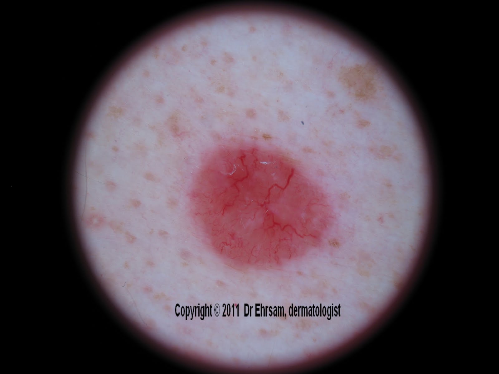 Dermoscopy Red Nodule