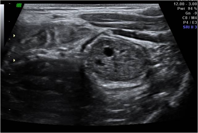 ‘DESCENDING COLONIC POLYP’- An ultrasound diagnosis - Sumer's Radiology ...