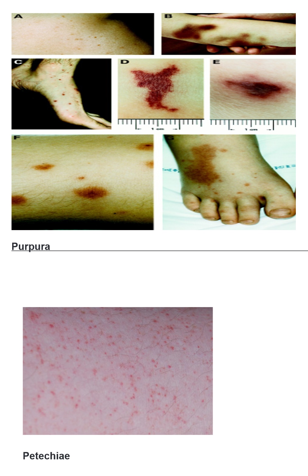 PLAB king: Non blanching rash (18/1700)
