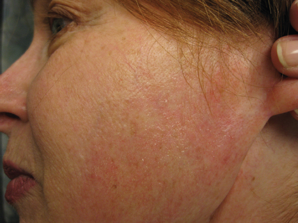 Dentistry and Medicine: Frey syndrome Short Note-Oral Medicine Lecture Note