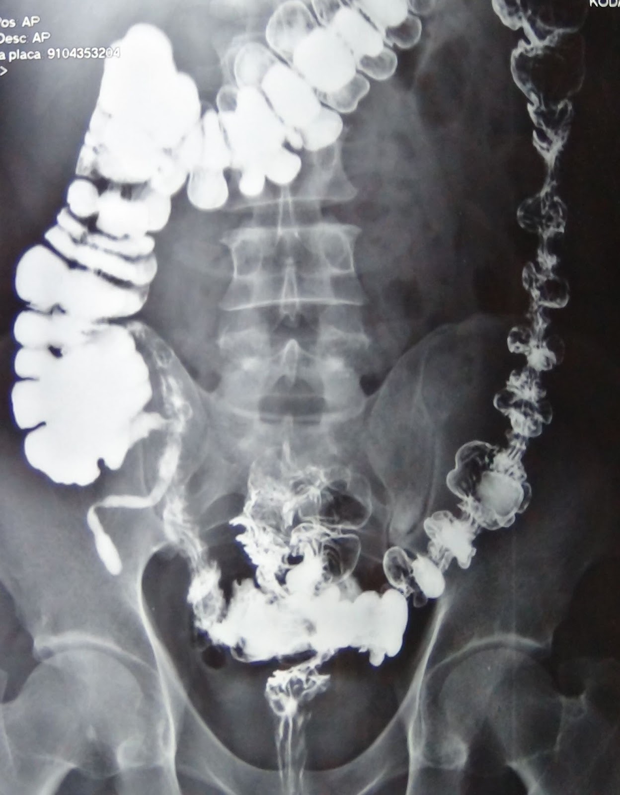 Endoscopia y Cirugía Digestiva: RADIOGRAFIA DE COLON POR ENEMA DE DOBLE ...