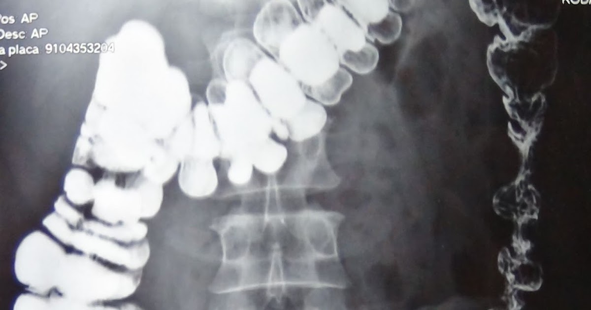 Endoscopia y Cirugía Digestiva: RADIOGRAFIA DE COLON POR ENEMA DE DOBLE ...