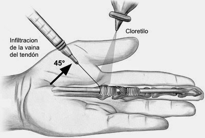 Cirugía de la Mano y Microcirugía: Dedo En Resorte (Gatillo ...