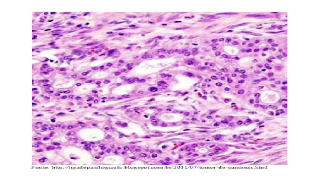 Atlas virtual de histologia e patologia: [CC II: #9] ADENOCARCINOMA DE ...