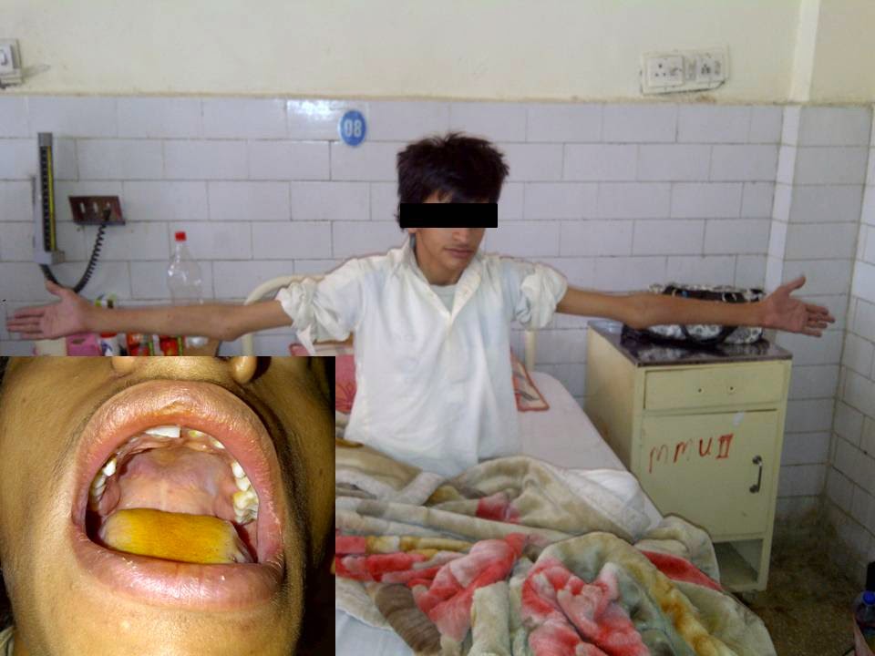 Marfanoid Habitus/Marfan Syndrome-Signs Symptoms-Clinical Picture