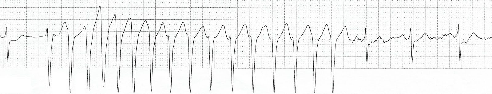 EKG Rhythm Strip Quiz 64