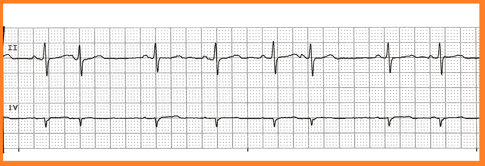 EKG Rhythm Quiz 223