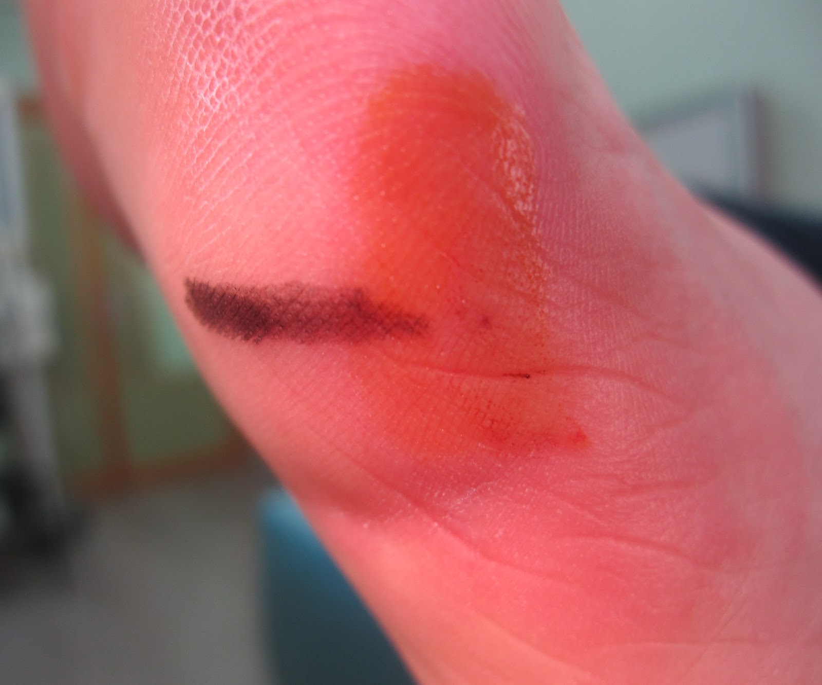 Podo Basas al Día: Heloma en fondo de saco ulcerado. Hallux extensus ...