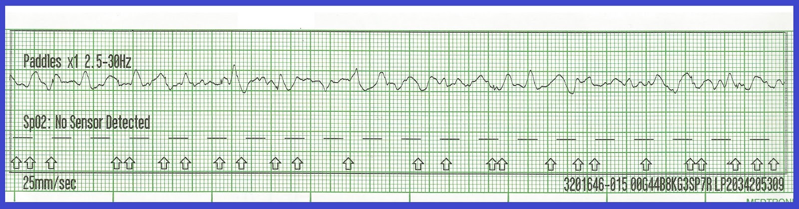 Code Blue: Sudden Cardiac Arrest