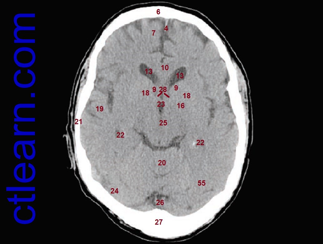 Anatomy CT Axial Brain