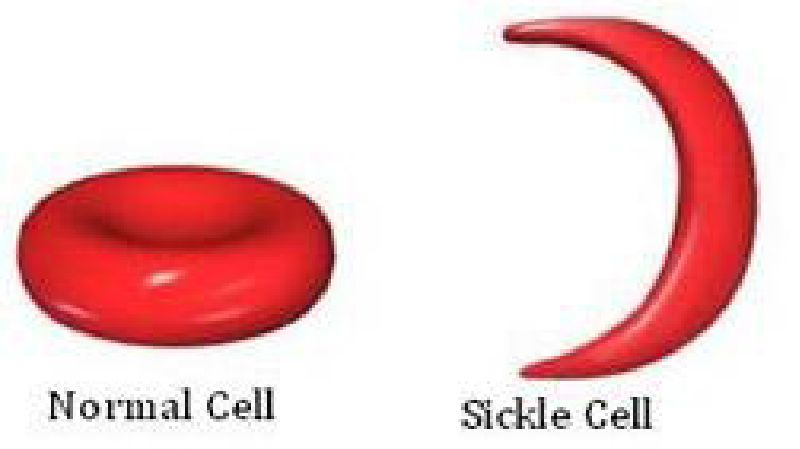 Health: Sickle Cell Anemia - Diary Of Doc Diva