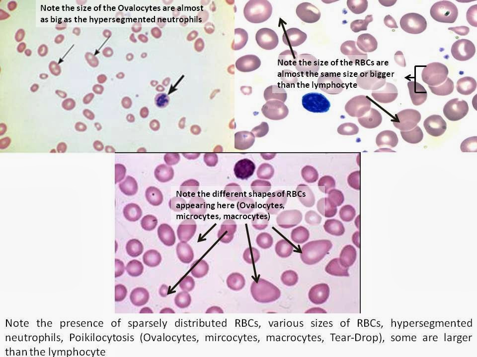 Haematology in a NutShell: Megaloblastic Anemia