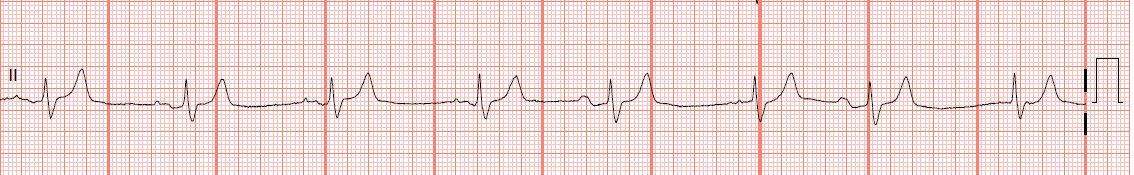 Float Nurse: EKG Rhythm Strips: Hyperkalemia part 3