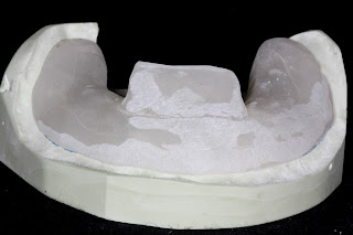 Boise Idaho Prosthodontics: Edentulous Custom Tray for PVS Impression ...