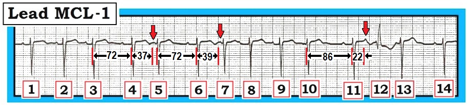 ECG Interpretation: ECG Blog #70 (PVC – Aberrancy – Ashman)