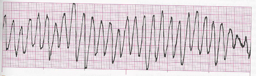 Polymorphic Ventricular Tachycardia | INA - ECG