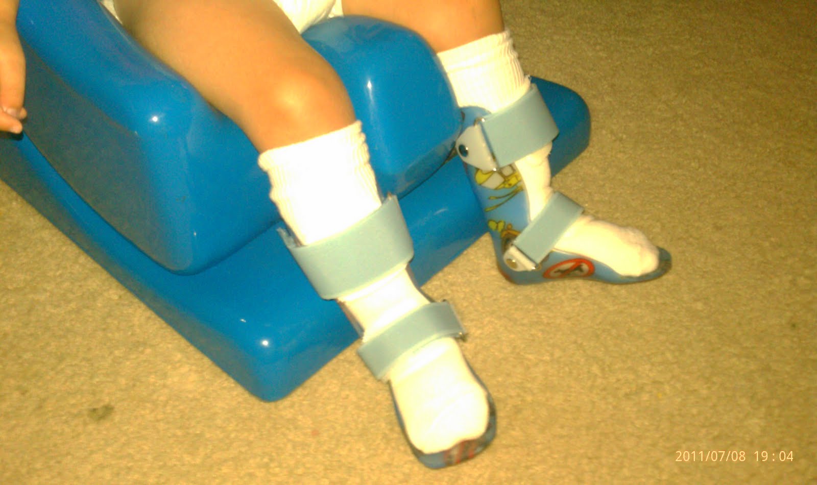 Mother of a Toddler and Triplets Plus ONE: Surgery and AFOs (adaptive ...