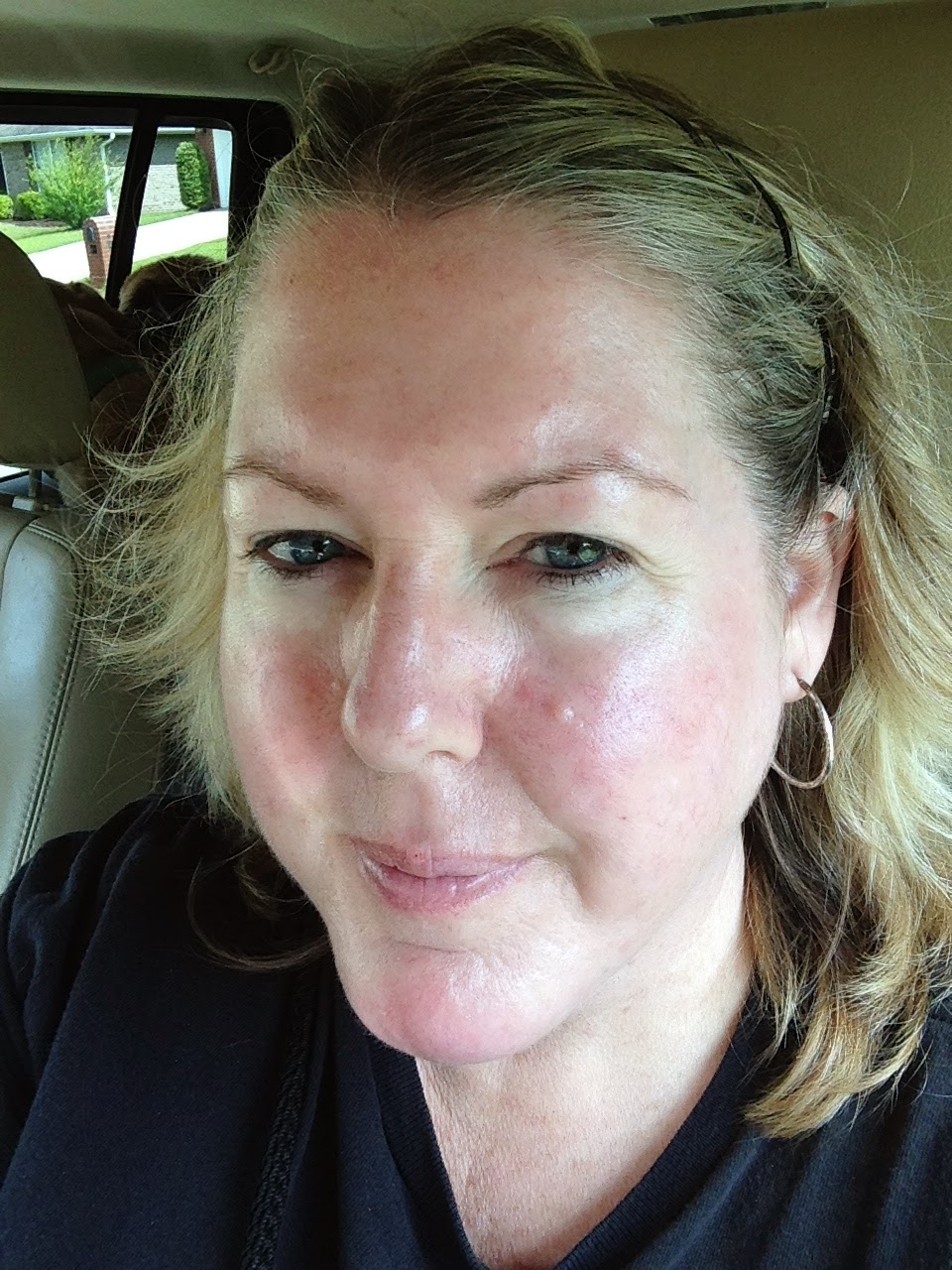 My Journey Through Topical Chemotherapy - Fluorouracil 5% Cream and ...