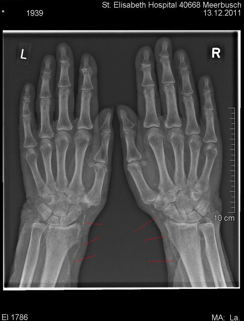 Rheumatologe: Arthrose Röntgenbilder der Hände - Osteoarthritis X-Rays ...