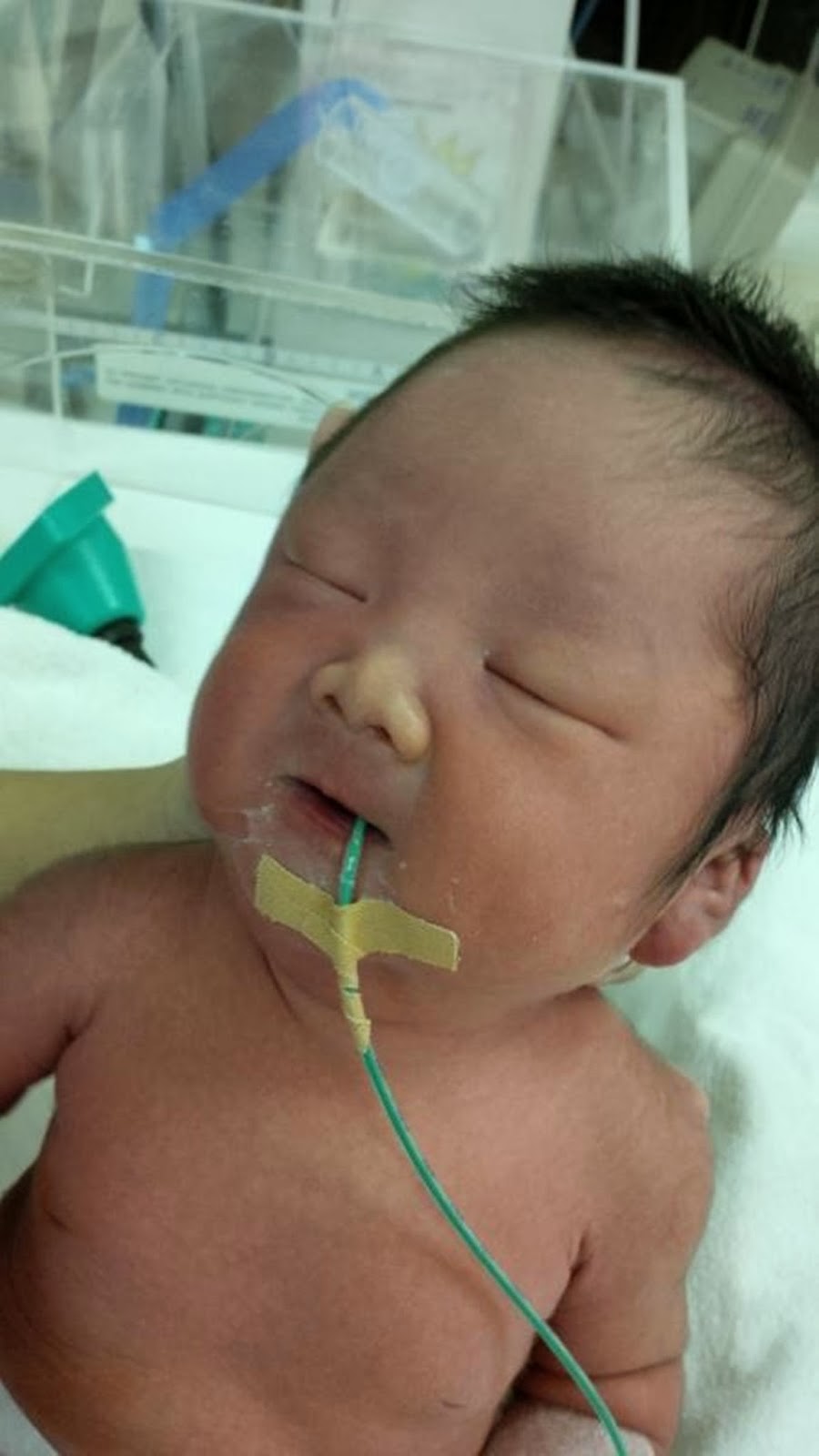 Sticky Bean's Birth Story at 34 weeks - Premature Baby