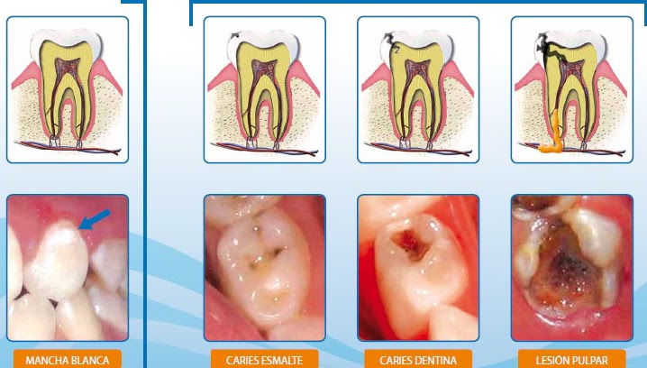 Dental Quetglas: Qué es la caries y cómo actúa