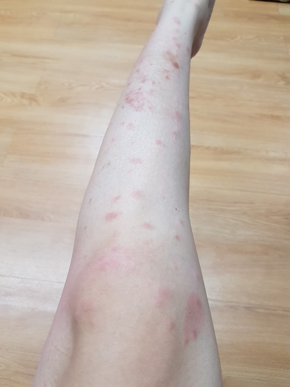 Patricia's story to tell: PUPPP - Skin rash due to pregnancy (in Bahasa ...