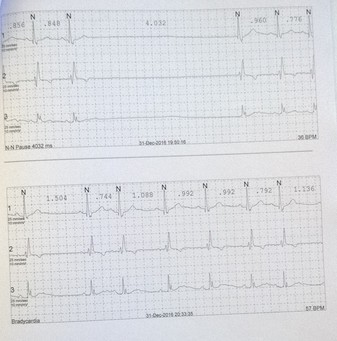 Cardiology window: Severe sinus node dysfunction in Old age male