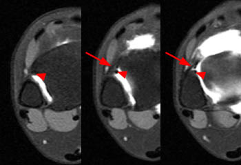 MRI Musculo-Skeletal Section: Accessory anterior inferior tibio-fibular ...