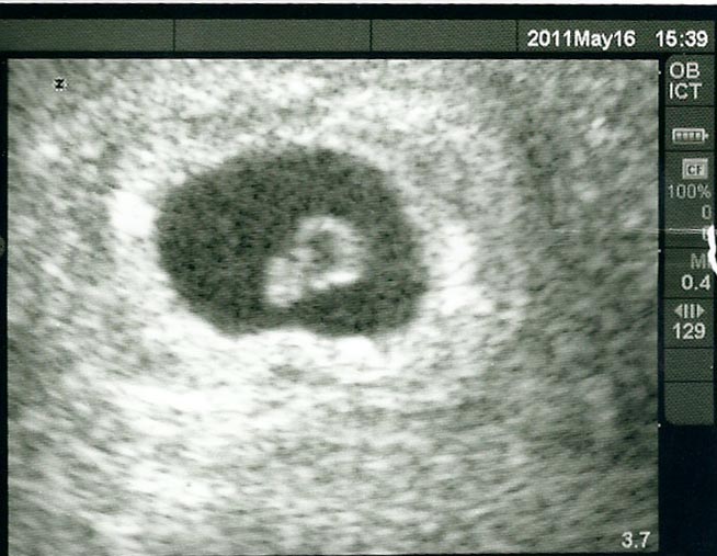 Our Pregnancy: 1st Ultrasound Appointment - 7 weeks