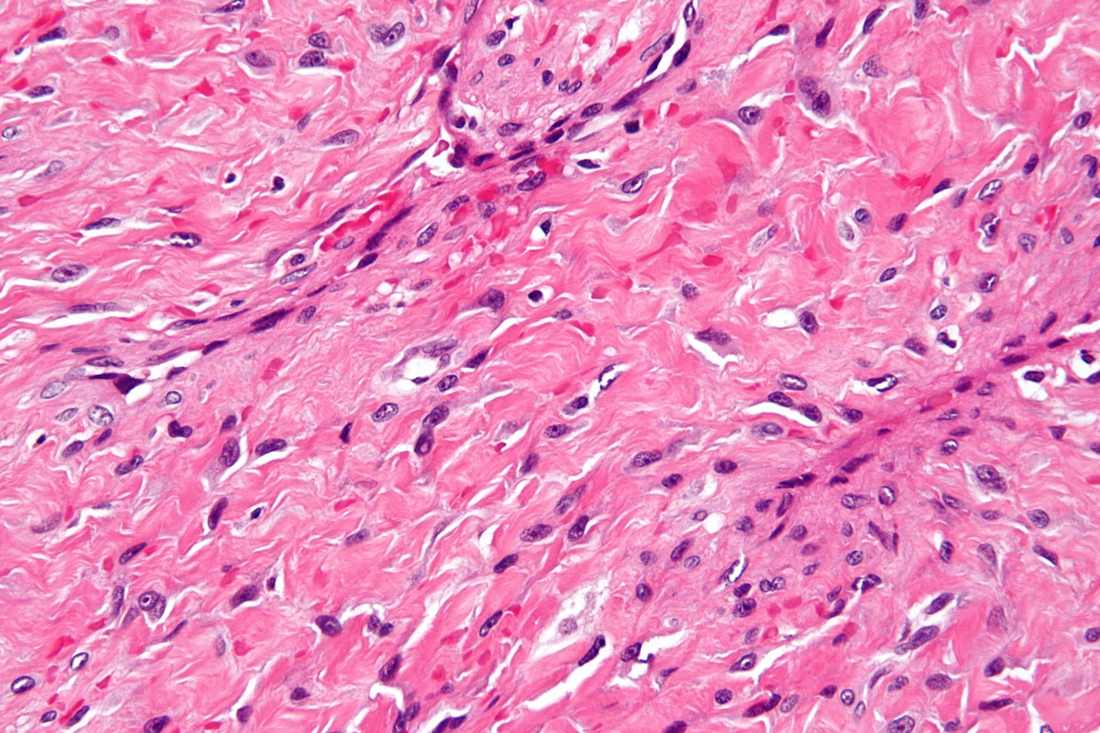 The Soft Tissue Tumor Files: Oh shoot, another fibroma!