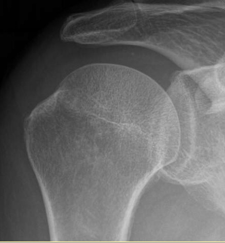 UW Shoulder and Elbow Academy: Avascular necrosis of the humeral head ...