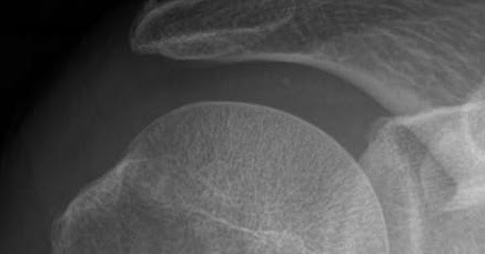 UW Shoulder and Elbow Academy: Avascular necrosis of the humeral head ...