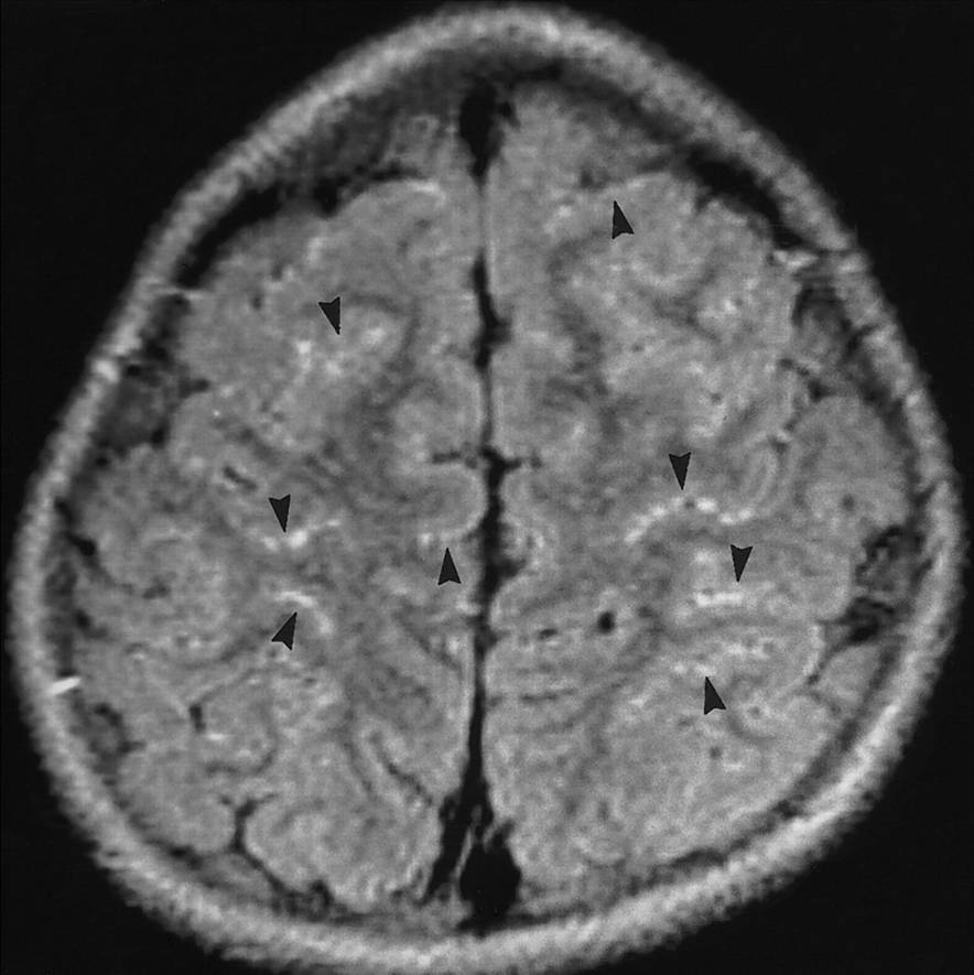 ABC Radiology Blog: Ivy Sign