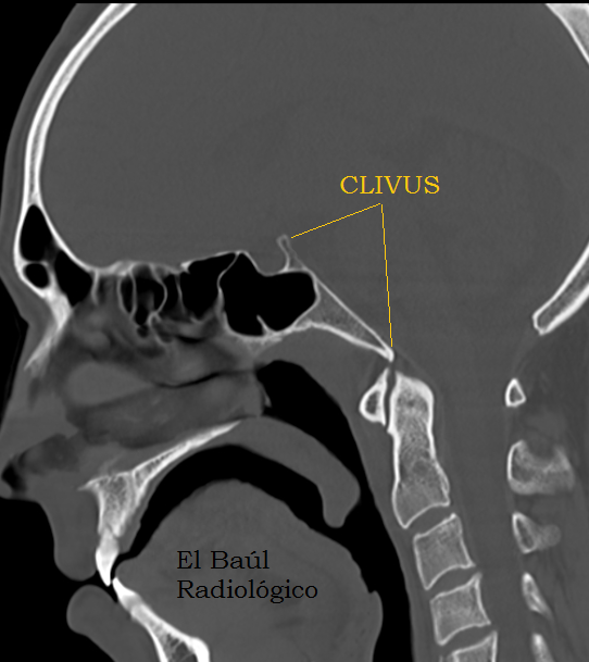 El Baúl Radiológico: SINCONDROSIS ESFENOBASILAR. (Sphenobasilar ...