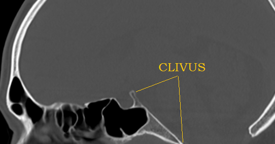 El Baúl Radiológico: SINCONDROSIS ESFENOBASILAR. (Sphenobasilar ...