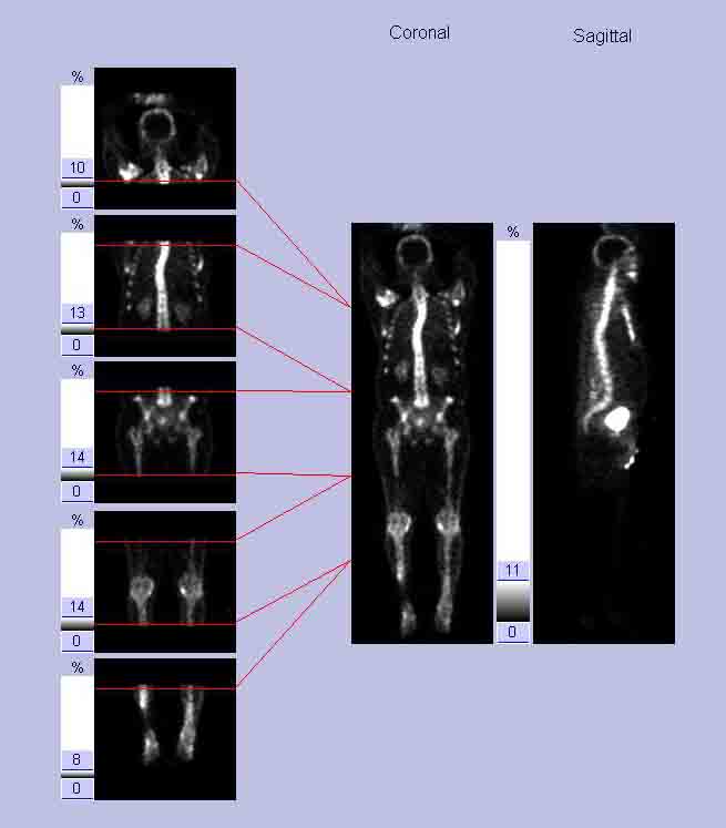 Nuclear Medicine Technology Program: Whole Body Bone SPECT
