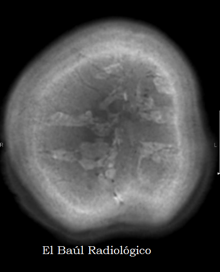 El Baúl Radiológico: CALCIFICACIONES DURALES EN TOMOGRAFÍA ...