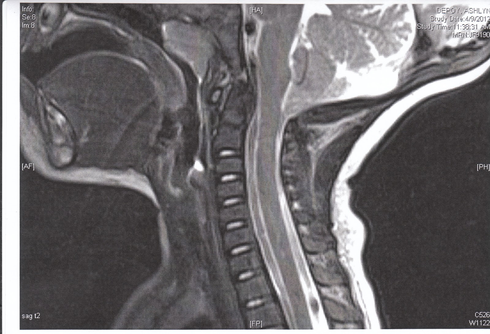 Chiari Hope: MRI Comparison
