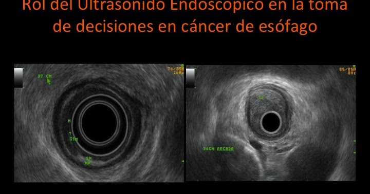 Endosonografía INCHIJAP: Rol del Ultrasonido Endoscópico en la toma de ...