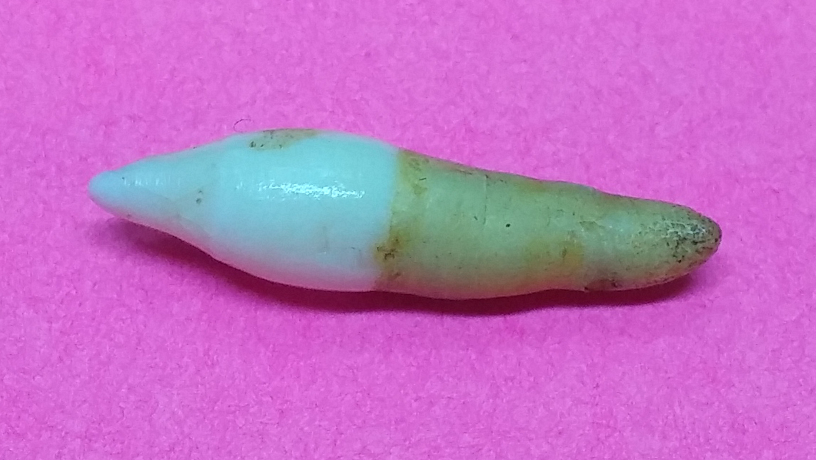 Exploriment: Conical Supernumerary Tooth