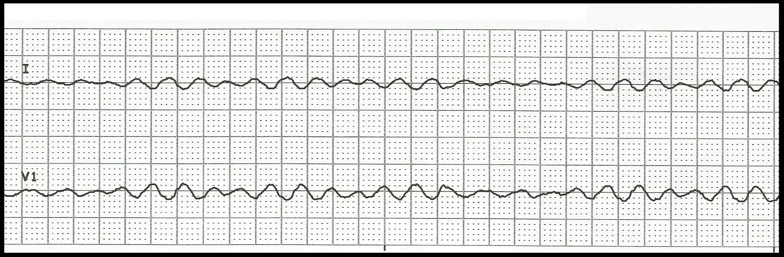 ECG Rhythm Strip Quiz 97: Ventricular Rhythms