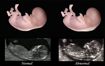 Life and Love in the Petri Dish: Nuchal translucency screen results