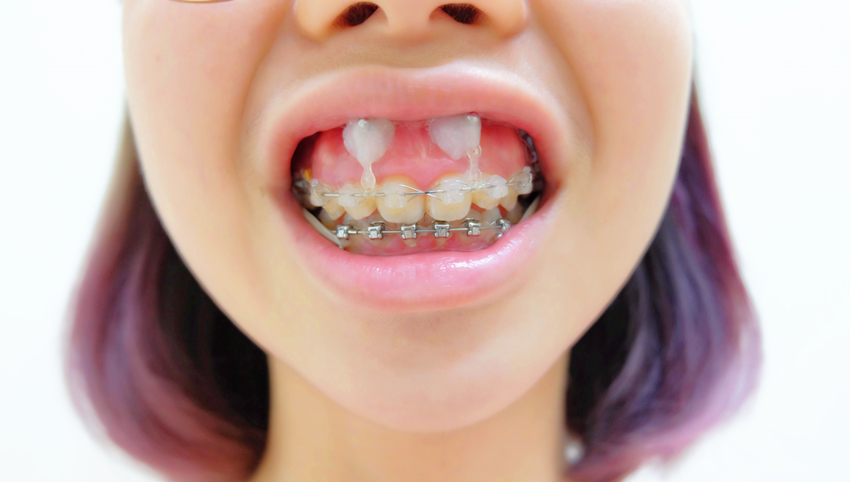 My Braces Story #3: Second and Final Stage (Put on 4 screws) | Chanwon ...