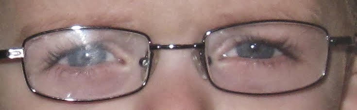 Xander's Eye Story, Cyclic Esotropia - Eye Patch Pattern - "Making ...