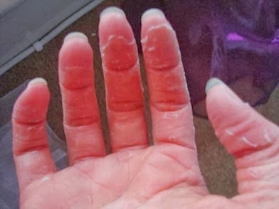 How to Get Rid of Peeling Fingertips - Tech and health Tips