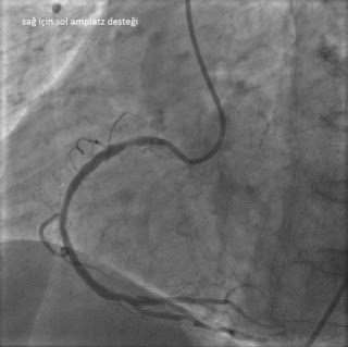 INTERVENTIONAL CARDIOLOGY TIPS AND CASES: GUIDING CATHETER SELECTION