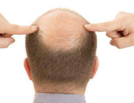 Things That Cause Men to Be Bald - benefitsit
